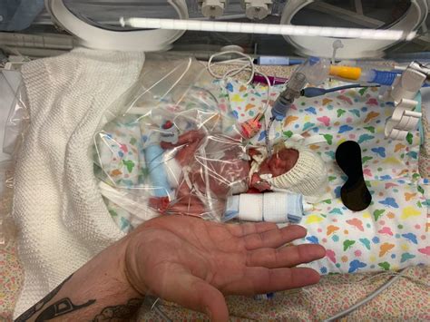 Baby Born Smaller Than Dad S Hand And Given 10 Chance Of Survival