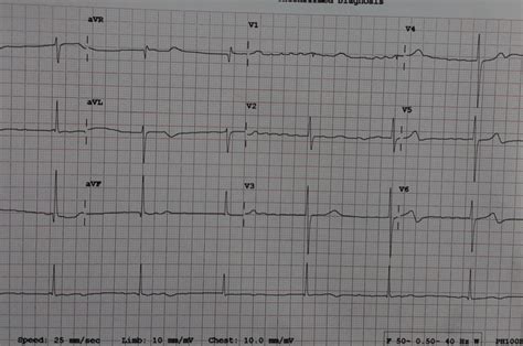 Understanding Afib Complications Signs Symptoms And Risk Reduction