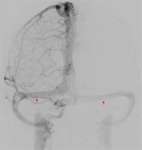 Sinus Transversus Ars Neurochirurgica