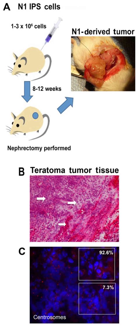 Aurora A Overexpression Is Linked To Development Of Aggressive