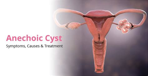 Anechoic Cyst Symptoms Causes And Treatment