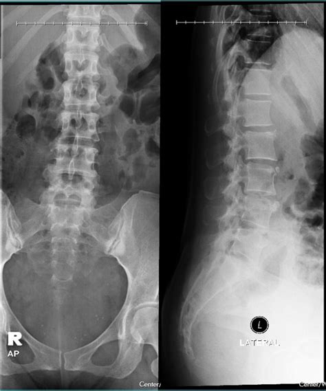 Condensing Osteitis X Ray At Nate Davidson Blog
