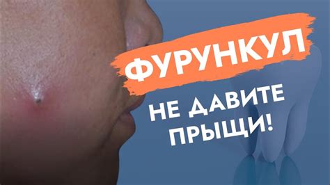 Чирей фурункул Не давите прыщи Youtube