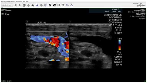 Upper Extremity Venous Mapping