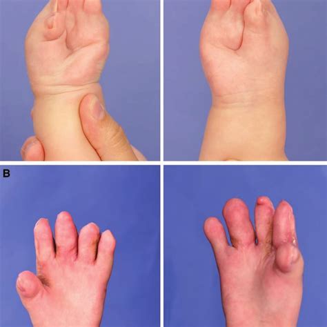 Michigan Hand Outcomes Questionnaires Scores Comparisons For Apert