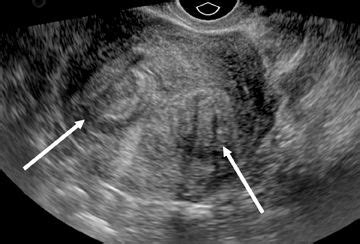 Uterus Uterine Conditions Pictures