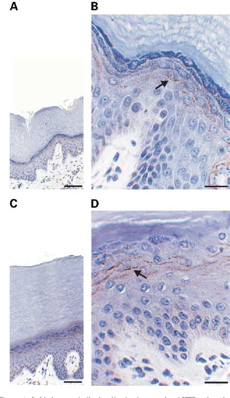 Hidrotic Ectodermal Dysplasia Semantic Scholar