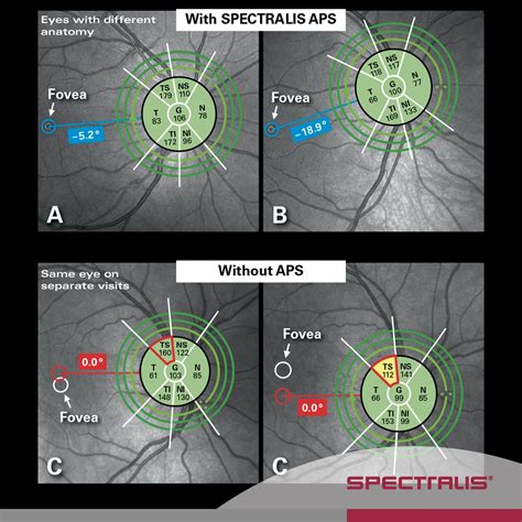 Spectralis Gmpe Glaucoma Glaucomadiagnosis Heidelberg Engineering Us
