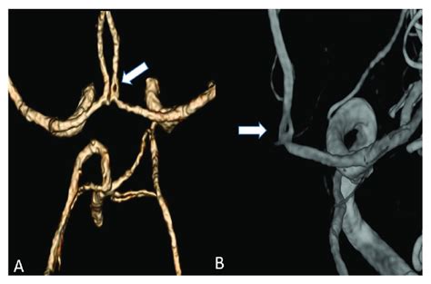 A Volume Rendering Of An Anterior Cerebral Artery Fenestration