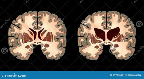 Brain Atrophy In Huntingtons Disease Cartoon Vector