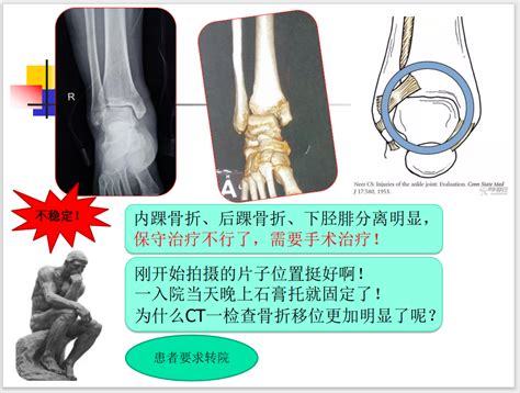 特殊的 Maisonneuve 骨折，超详细解析！ 德医学院 助力医学教育发展！
