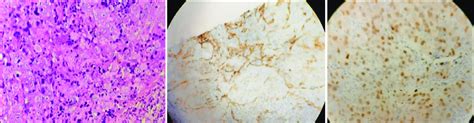 A Histopathological Examination Of The Tumor Cells Showed Atypical