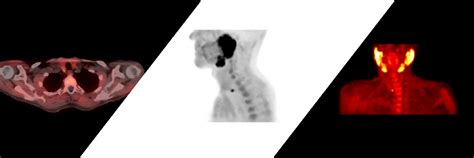 PET scan à la F Choline indication parathyroïdienne CIN Centre d