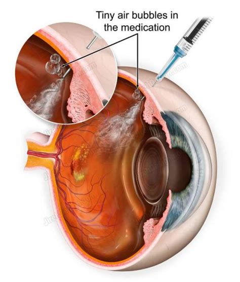 Anti Vegf Injection Bubbles Suvr0089 Stock Eye Images