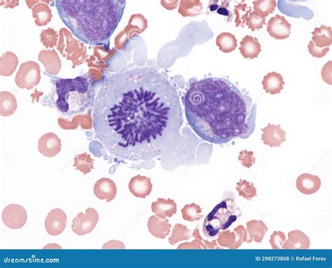 Lymphoma Cells Cytology