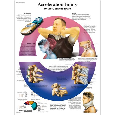 Acceleration Injury To The Cervical Spine Chart Sem Trainers