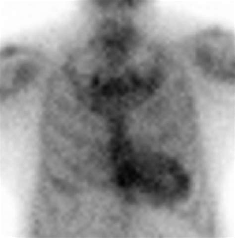 M Technetium Pyrophosphate Cardiac Amyloid Imaging Scan Showing Grade Download Scientific