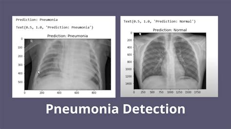 pneumonia detection model using deep learning deep learning projects codersarts ai
