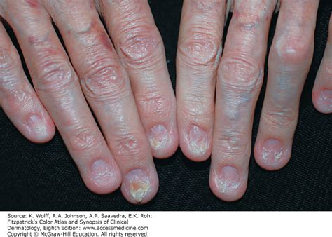 Toenail Icd 10 At Mildred Meyer Blog