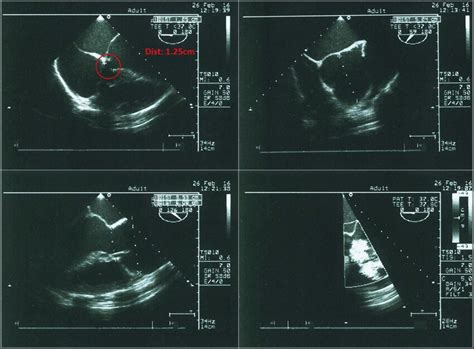 Transesophageal Echocardiography Views Download Scientific Diagram