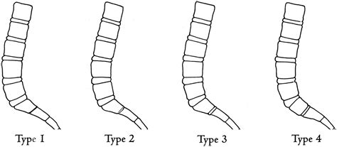 Transitional Lumbosacral Anatomy Explore Organs And Anatomy Diagram
