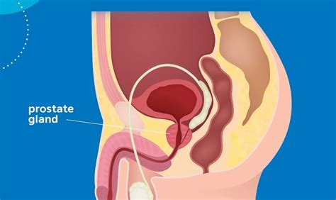 More Than Half Of People With Prostate Cancer In Yorkshire Diagnosed At Late Stage Yorkshire