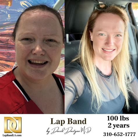 Bariatric Surgery Before And After Fiona Lap Band Los Angeles
