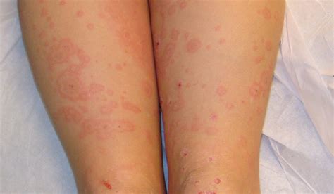 O Que é Eritema Multiforme Retoedu