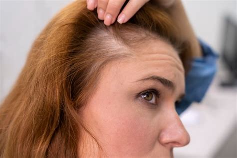 Telogen Effluvium What Is It Cibo Clinic ️