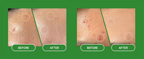 Troubless Invisible Pimple Spot Patch Classic Hydrocolloid Pimple