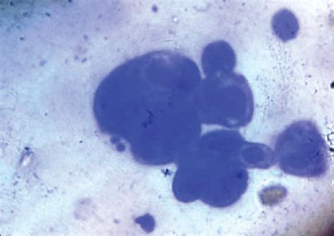 2020 2 17 Herpes Simplex Our Dermatology Online