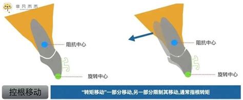 正畸生物力学知识——牙齿移动类型 知乎
