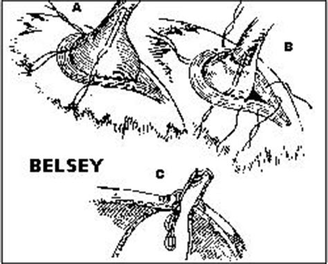 Belsey Mark Iv
