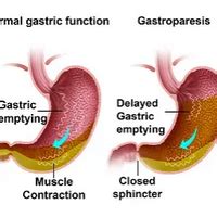 Gastroparesis Discussion On PDB