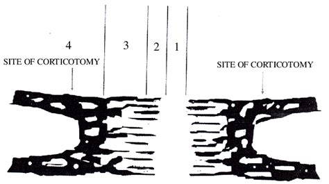 Site Of Corticotomy Download Scientific Diagram