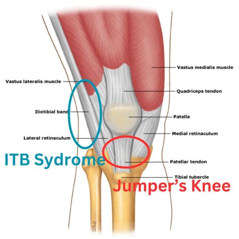 運動員傷不起的膝頭哥 Itb Syndrome Iliotibial Band Syndrome 的意思是「髂腸束綜合症」，它是一種在