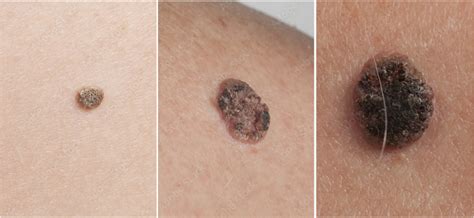 Campanha Melanoma Msd Brasil