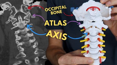 Atlantoaxial And Atlanto Occipital Joints C1 C2 Atlas And Axis