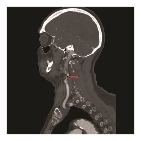 A A Ct Angiogram Showing A Persistent Trigeminal Artery Arising From Download Scientific