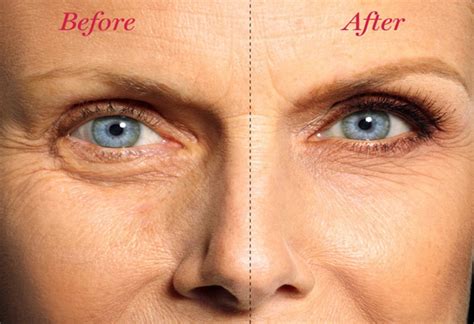 How To Get Rid Of Undereye Bags