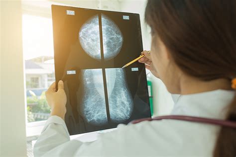 Private Mammogram Scan Without Referral Near You Uk