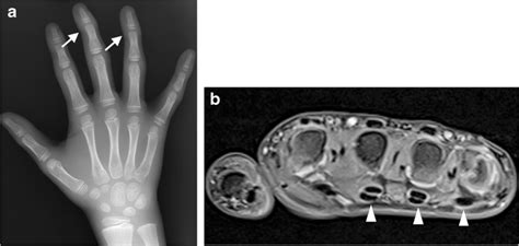 Drug Induced Arthritis In A 15 Year Old Girl With Tuberous Sclerosis