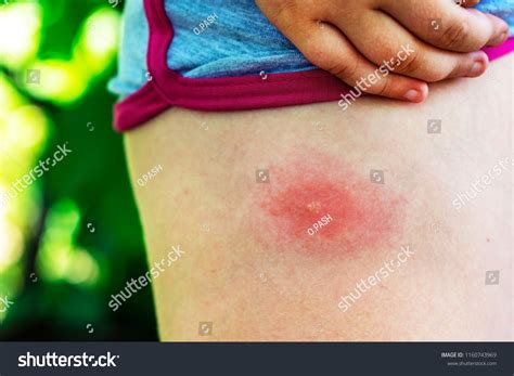 334 Imagens De Tick Bite Rashes Imagens Fotos Stock E Vetores