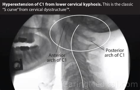 Craniocervical Instability Fund On Linkedin Cervical Spine Realignment