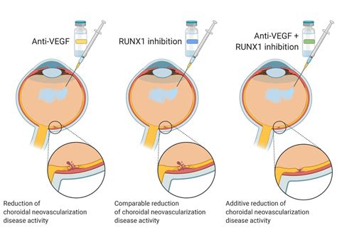 Choroidal Neovascularization