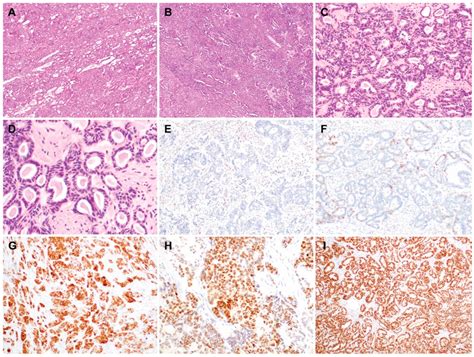 Histological And Immunophenotypical Features Of Uterine Download