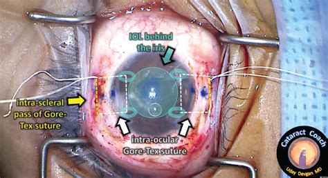 Iol Fixation Pearls From The Pros