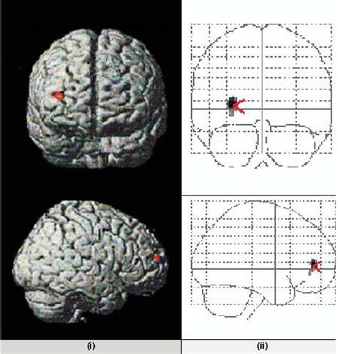 Coexisting Areas Of Anatomical I And Functional Ii Abnormalities In