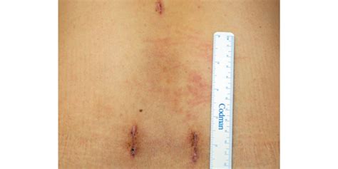 Mi Tlif Conheça Essa Técnica Cirúrgica