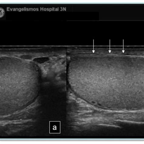Normal Testicular Appendages A Appendix Testis With Calcifications